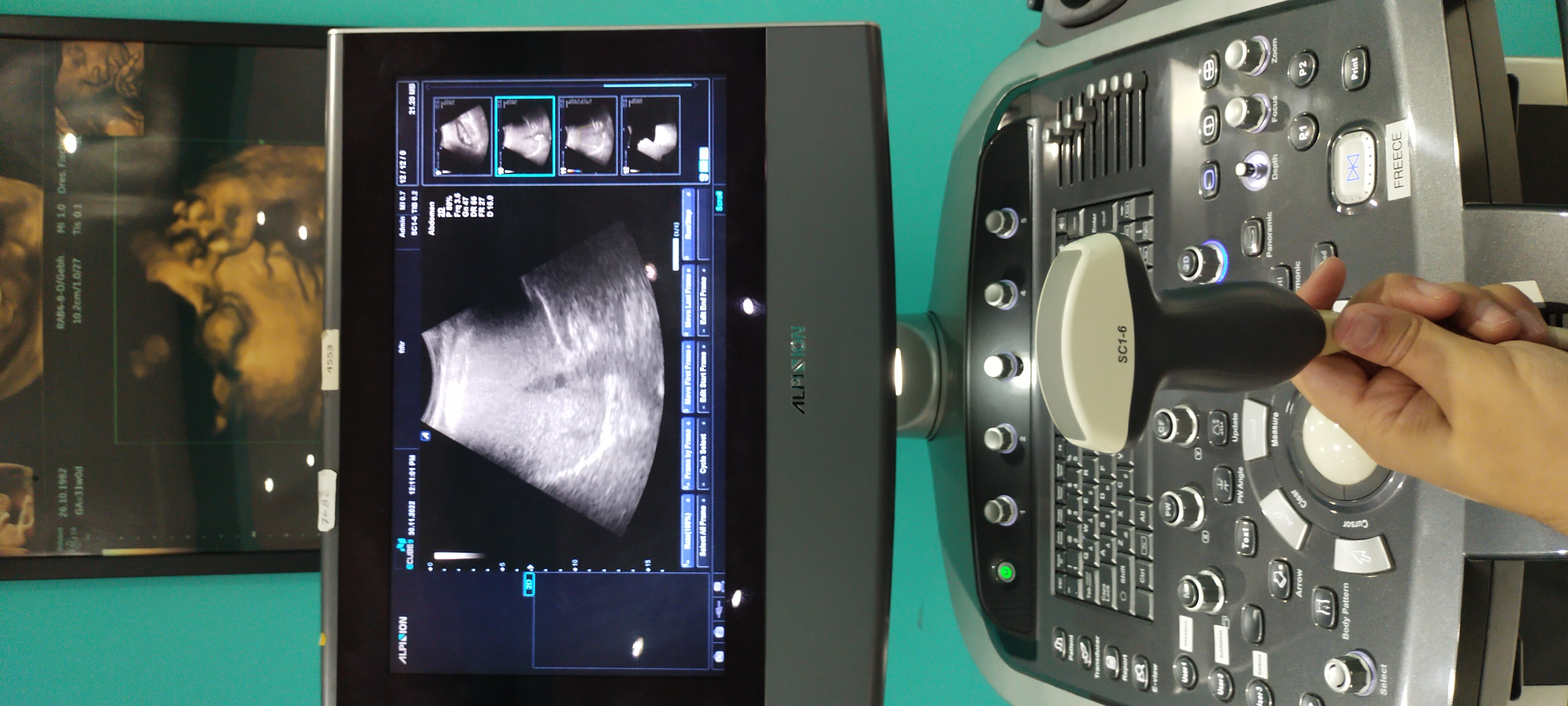 Alpinion E cube 9 Ultraschallgerät